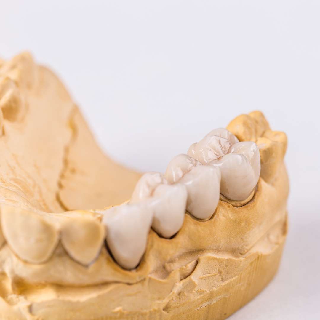 Protesi dentale fissa Roma